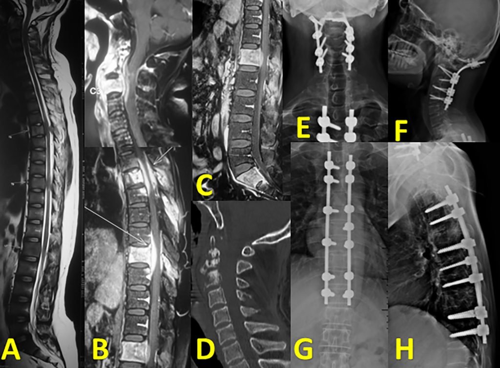 Surgery For Tuberculosis Spine In Nagpur Dr Paresh Bang
